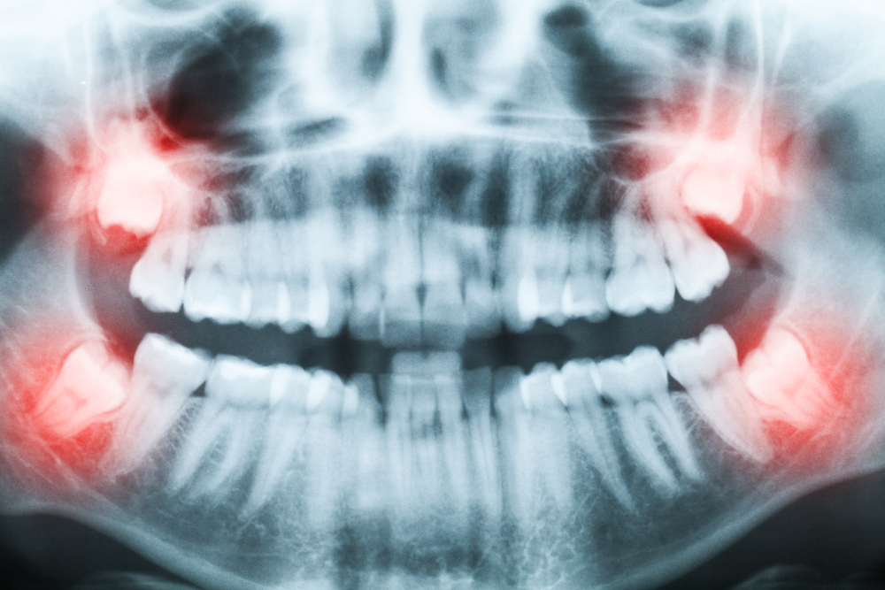 Wisdom Teeth, Your Third Molars | Fargo, North Dakota